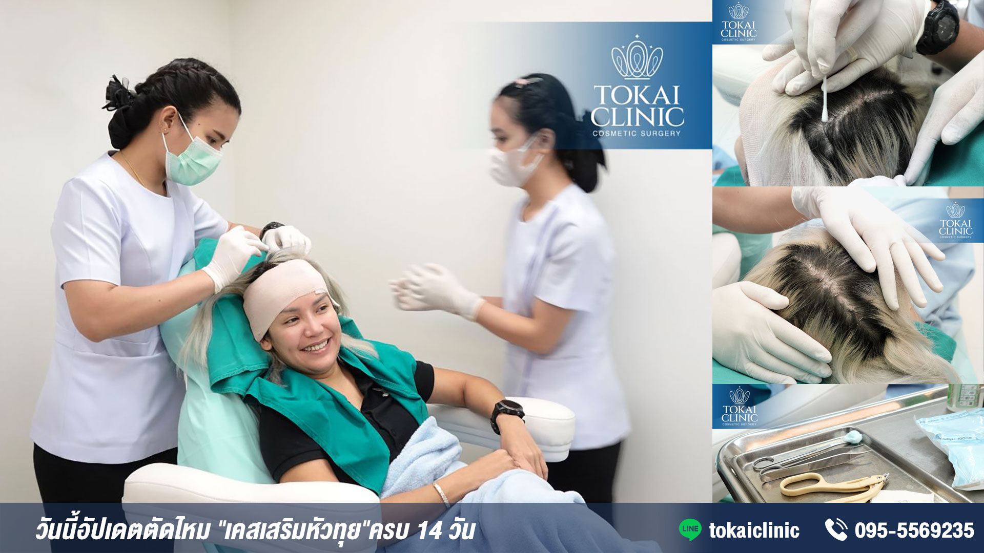 Update today: case of occipital augmentation surgery completed in 14 ...