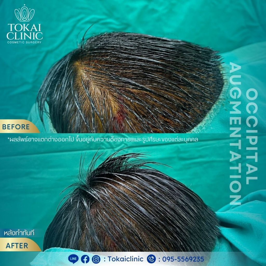 Updated after Mr. Kao After about “Occipital Augmentation”. – TOKAI CLINIC