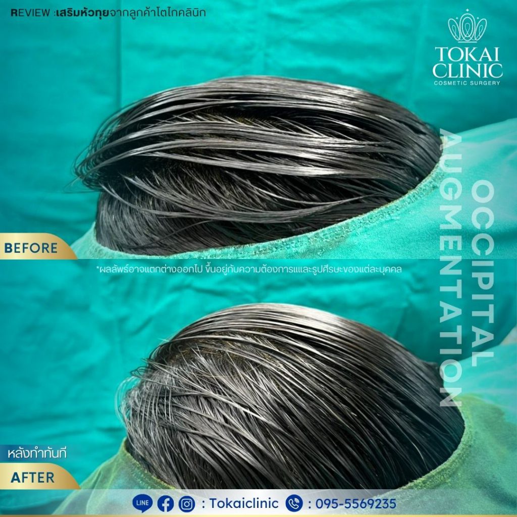 Occipital back of head augmentation surgery with Tokai Clinic. For more ...