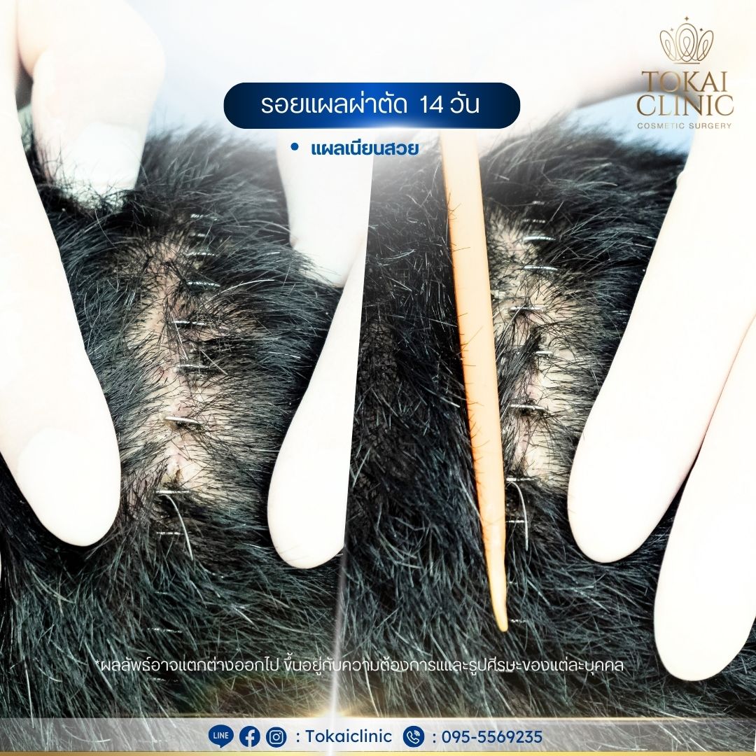 อัปเดตความทุย หลังทำ 14 วันตัดไหม! – TOKAI CLINIC